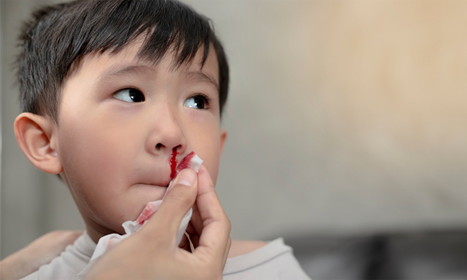 குழந்தைகளுக்கு மூக்கிலிருந்து இரத்தம் வரக்காரணம்... | Epistaxis for ...